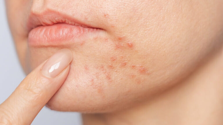 Periorificial Dermatitis | Online Treatment | Digital Dermatology